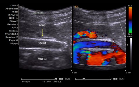 Eco-Doppler | Unidad de Patología Vascular