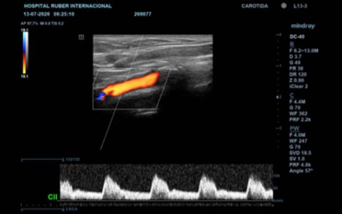 Eco-Doppler | Unidad de Patología Vascular