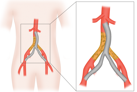 Cirugía Vascular | Unidad de Patología Vascular
