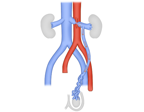 Varicocele Testicular | Unidad de Patología Vascular
