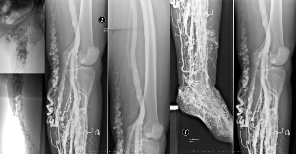 Estética vascular | Unidad de Patología Vascular